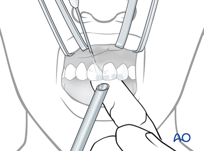 Splint for Tooth fracture, root fracture