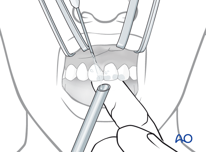 Splint for Tooth fracture, root fracture