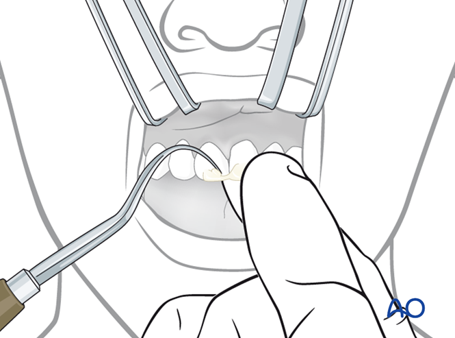 Splint for Tooth fracture, root fracture