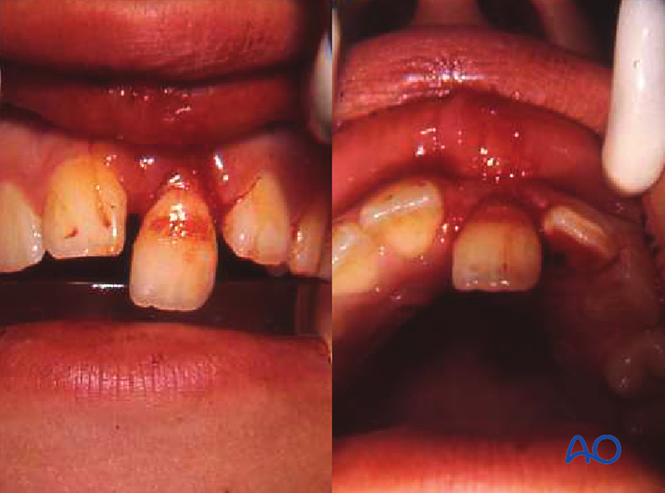 Tooth luxation with displacement - Extrusion