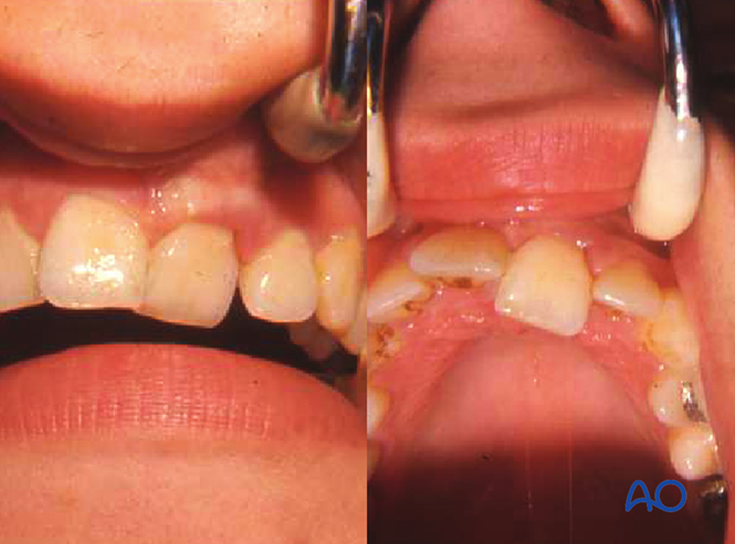 Tooth luxation, with displacement - Lateral luxation