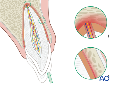 Tooth luxation with displacement - Intrusion