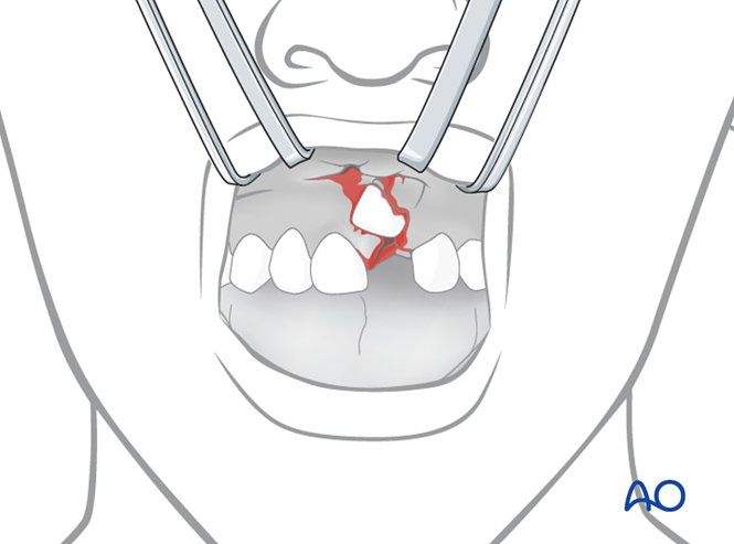 Repositioning and fixation for Tooth luxation with displacement - Intrusion