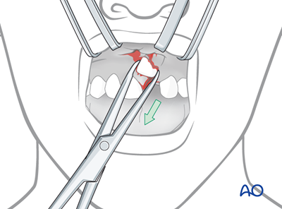 Repositioning and fixation for Tooth luxation with displacement - Intrusion