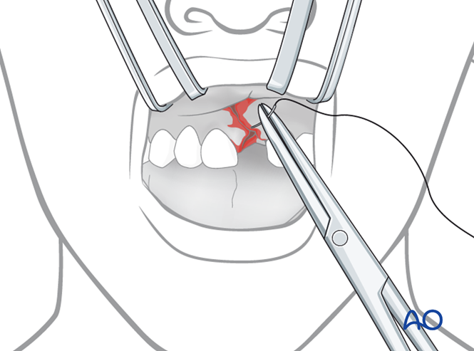Repositioning and fixation for Tooth luxation with displacement - Intrusion