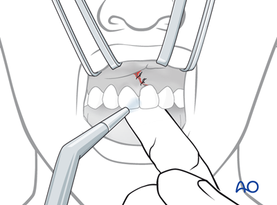 Repositioning and fixation for Tooth luxation with displacement - Intrusion