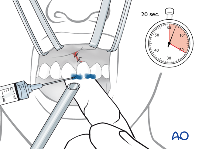 Repositioning and fixation for Tooth luxation with displacement - Intrusion