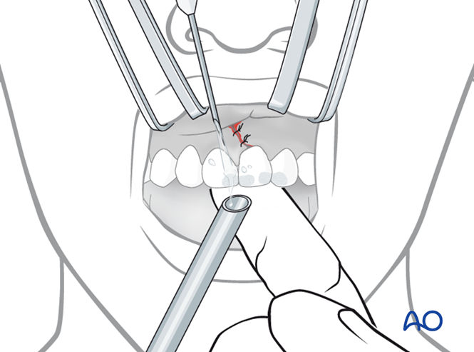 Repositioning and fixation for Tooth luxation with displacement - Intrusion