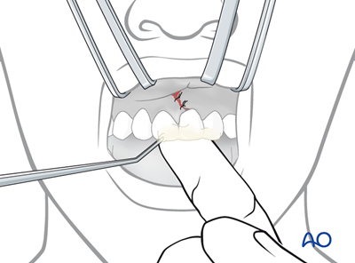 Repositioning and fixation for Tooth luxation with displacement - Intrusion