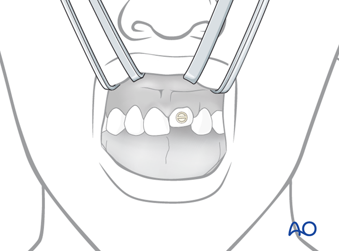 Repositioning and fixation for Tooth luxation with displacement - Intrusion