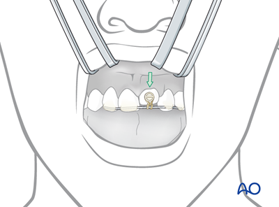 Repositioning and fixation for Tooth luxation with displacement - Intrusion