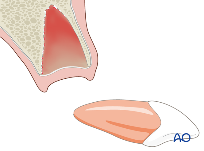Tooth luxation, avulsion (total luxation)