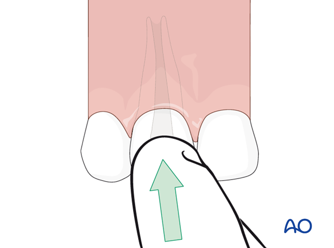 Various treatment options for Tooth luxation, avulsion (total luxation)