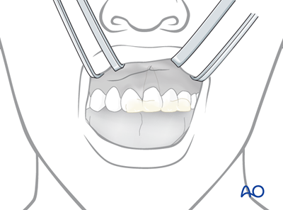 Various treatment options for Tooth luxation, avulsion (total luxation)
