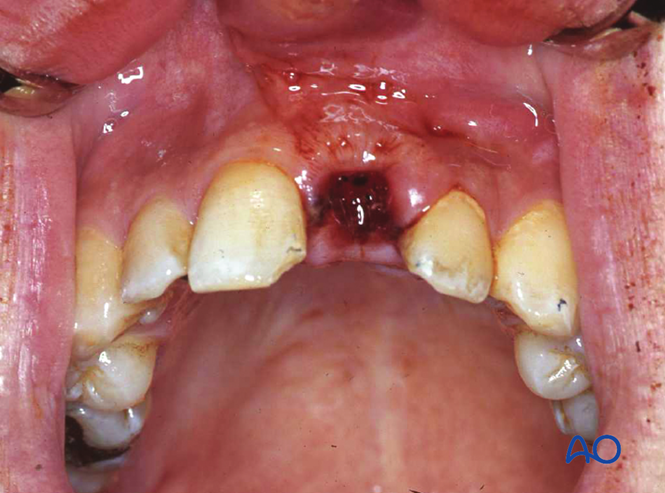 Tooth luxation, avulsion (total luxation)