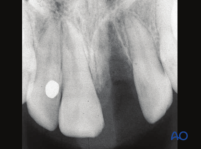 Tooth luxation, avulsion (total luxation)