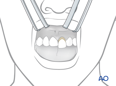 Tooth fracture, root fracture