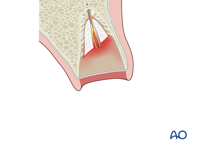 Splint for Tooth fracture, root fracture