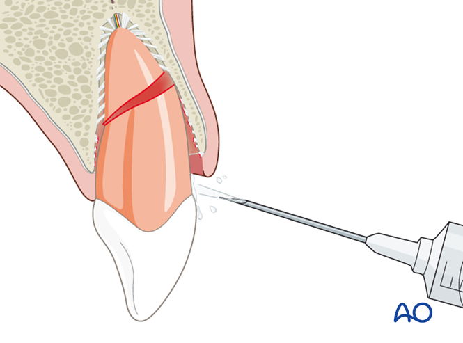 Splint for Tooth fracture, root fracture