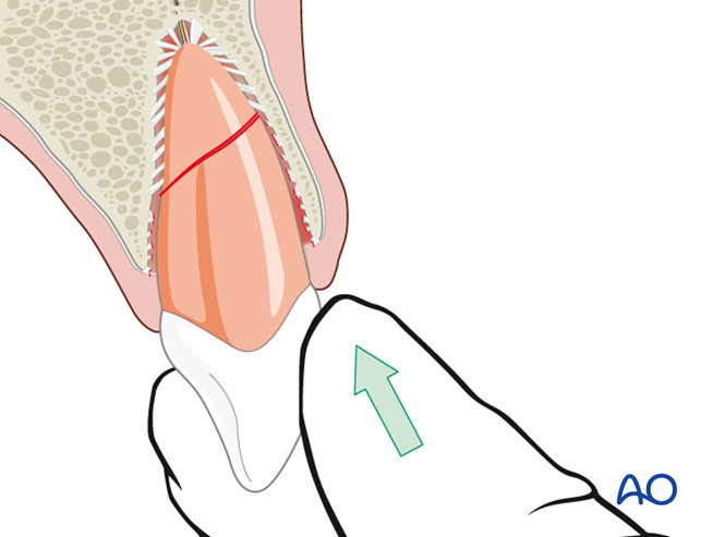 Splint for Tooth fracture, root fracture