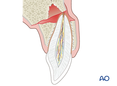 Alveolar fracture, segmental
