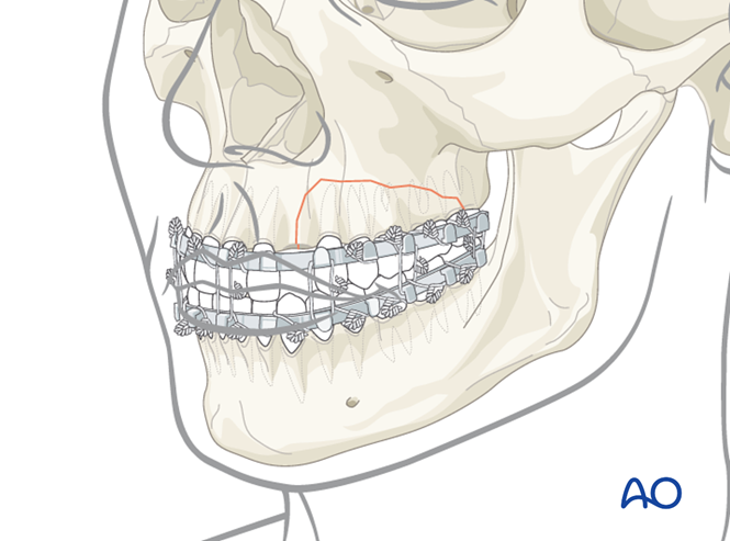 Open reduction internal fixation for Alveolar fracture, segmental