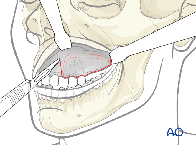 Open reduction internal fixation for Alveolar fracture, segmental