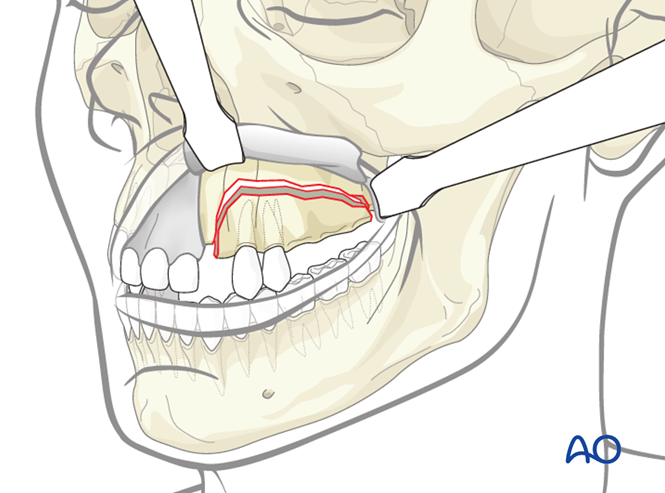 Open reduction internal fixation for Alveolar fracture, segmental