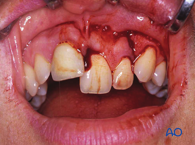 Alveolar fracture, segmental