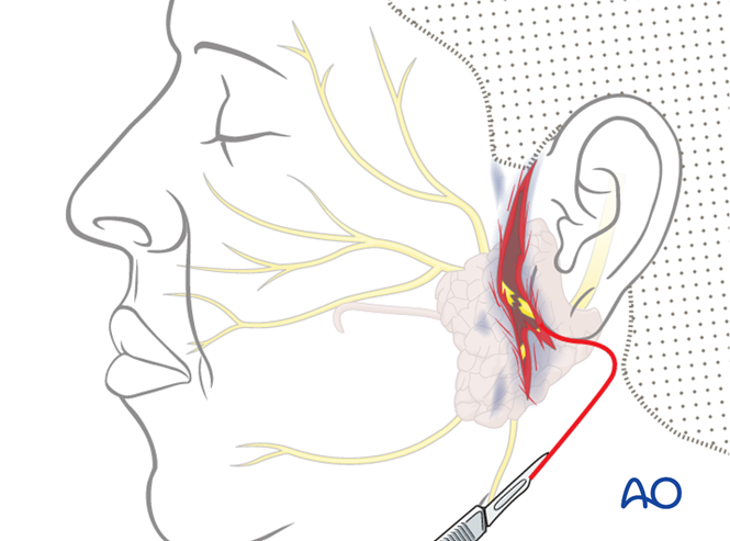The use of existing lacerations