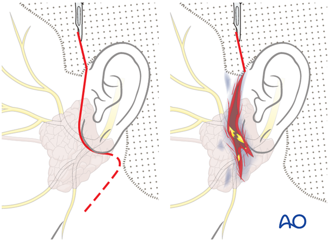 Interpositional nerve graft for Reversible paralysis