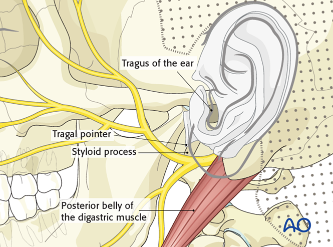 Interpositional nerve graft for Reversible paralysis