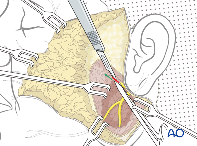 Interpositional nerve graft for Reversible paralysis