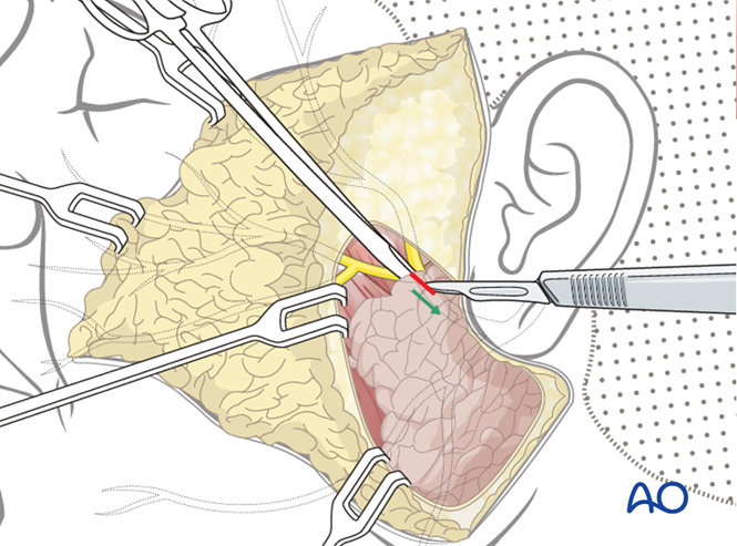 Interpositional nerve graft for Reversible paralysis
