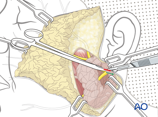 Interpositional nerve graft for Reversible paralysis