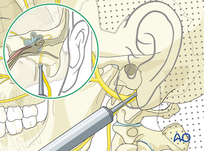 Interpositional nerve graft for Reversible paralysis