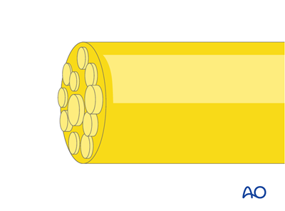Interpositional nerve graft for Reversible paralysis