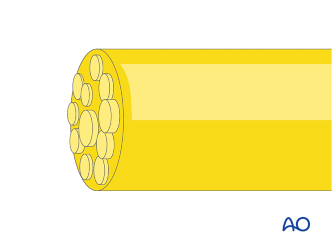 Interpositional nerve graft for Reversible paralysis