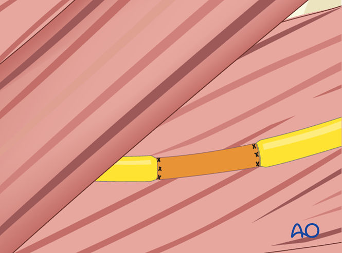 Interpositional nerve graft for Reversible paralysis