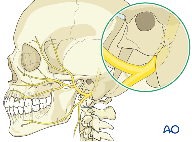 Interpositional nerve graft for Reversible paralysis