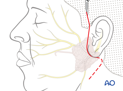 Reinnervation with masseteric nerve transposition for Reversible paralysis