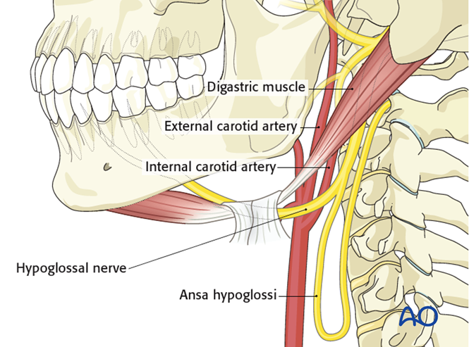 Reinnervation with hypoglossal nerve for Reversible paralysis