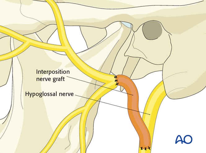 Reinnervation with hypoglossal nerve for Reversible paralysis