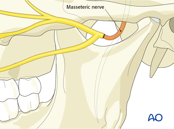 Reinnervation with masseteric nerve transposition for Reversible paralysis