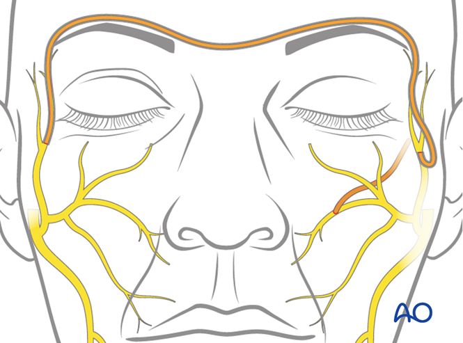 Selective reinnervation with contralateral facial nerve and masseteric ...