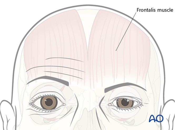 Direct brow lift for Irreversible paralysis, eye complex