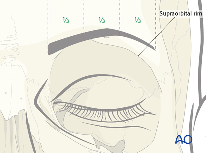 Direct brow lift for Irreversible paralysis, eye complex