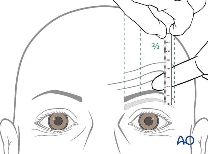 Direct brow lift for Irreversible paralysis, eye complex