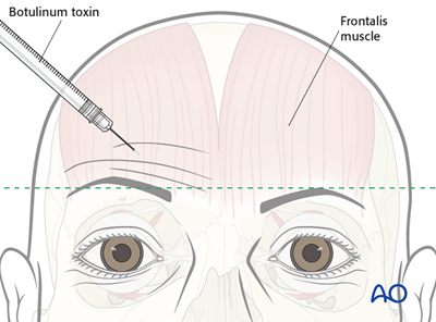 Direct brow lift for Irreversible paralysis, eye complex