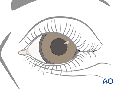 Lateral tarsorrhaphy for Irreversible paralysis, eye complex